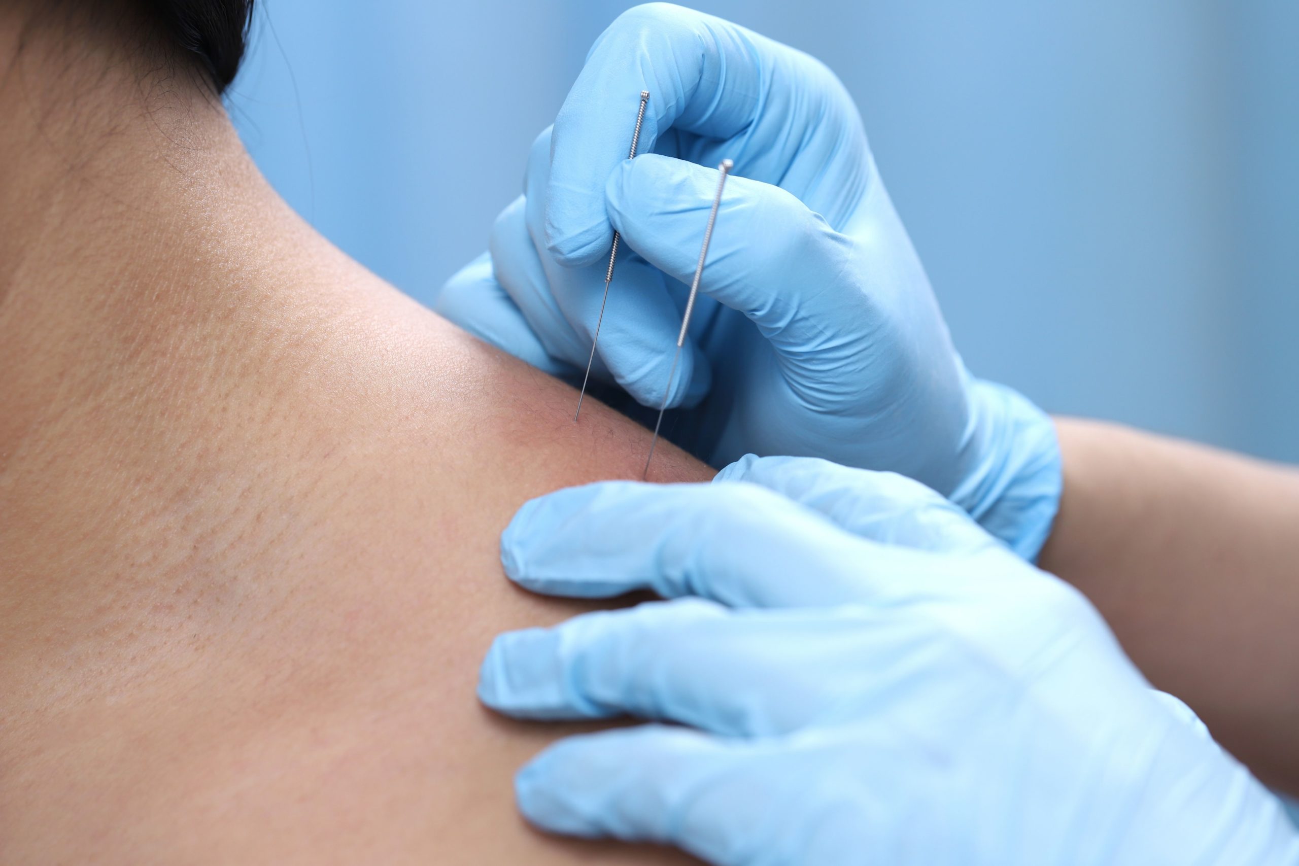 Neuropuncture - The Complete Neuroscience Acupuncture System